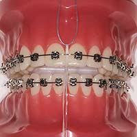 Flossing with braces | Dr. Benito Benitez | Dallas Orthodontics