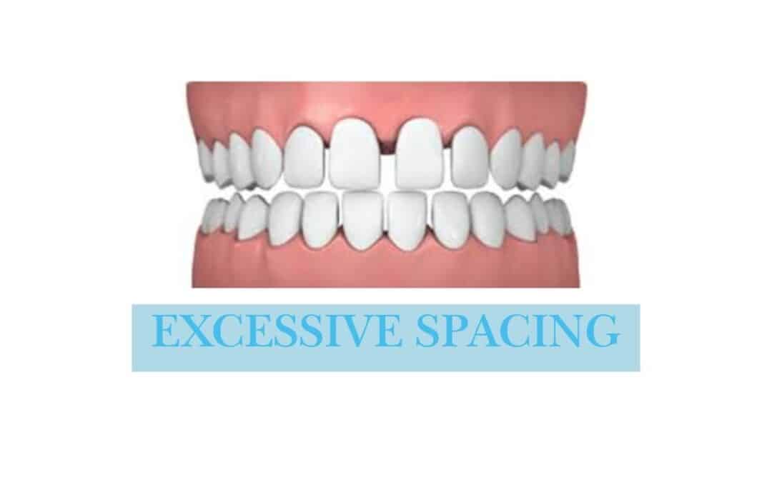 How Do You Fix Excessive Spacing in Teeth?